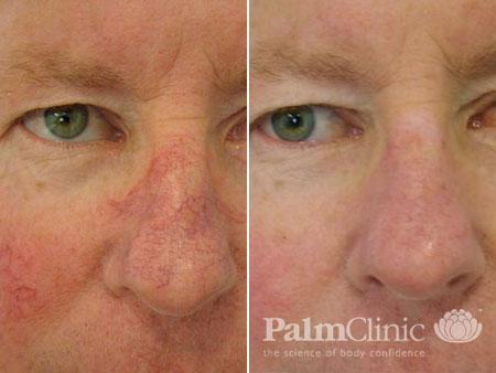 Broken and Spider Veins - Causes, Removal & Treatments - Auckland NZ ...